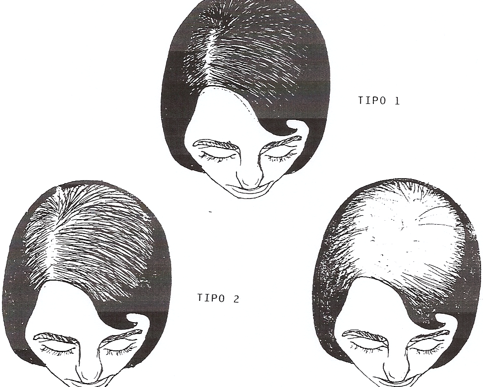 calvizie-andro-genetica-femminile | miAgenda Blog